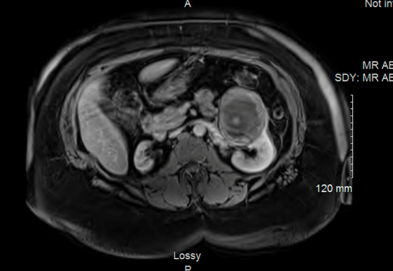 Virtual Tumor Board - Michigan Urological Surgery Improvement ...